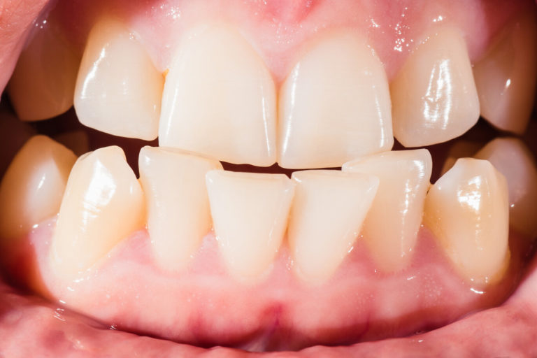 Teeth Shifting Causes and Prevention Cumming | Serenity Orthodontics